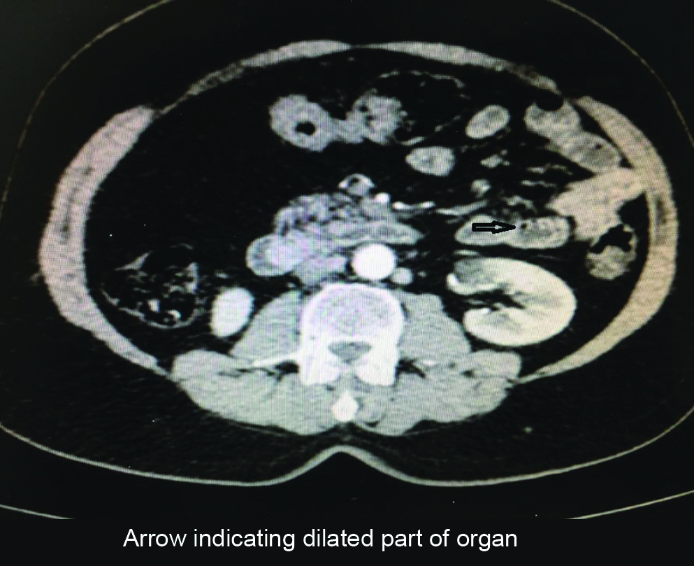 Computer Tomography of NET presenting as ampullary polyp causing ...