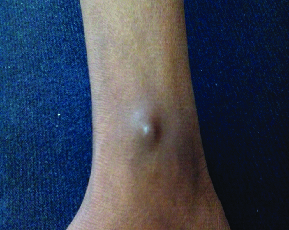 Nodule on left leg.