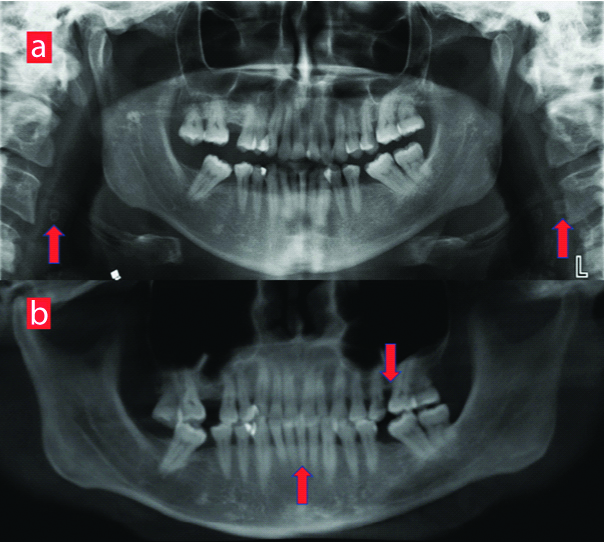 a) Panoramic radiography showing nodular calcification anterior C3-C4 ...