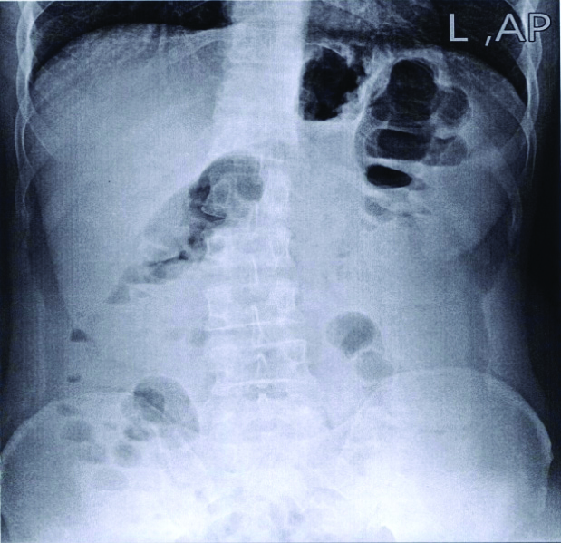 Plain abdominal X-ray.