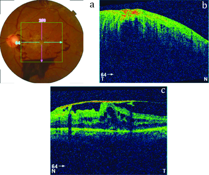 a) Fundus photograph OS at admission; b) OCT scan OD at admission; c ...