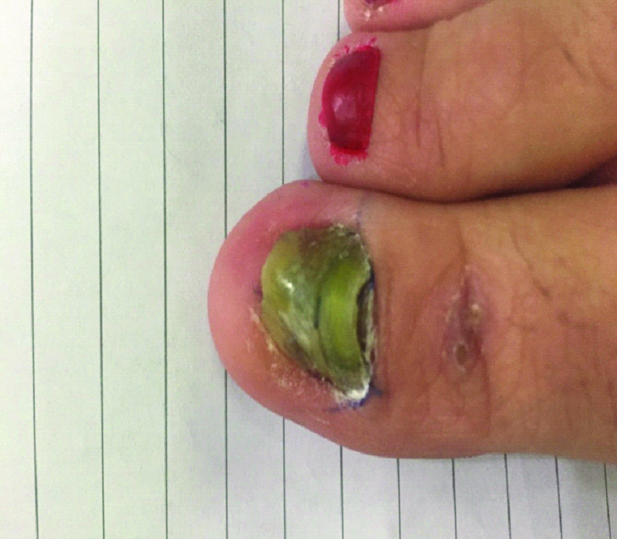 Dystrophic changes in the nail plate and extensive yellowish-green ...