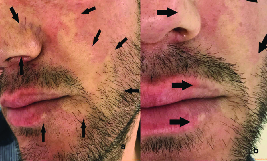 blanching of the skin - Captions Week