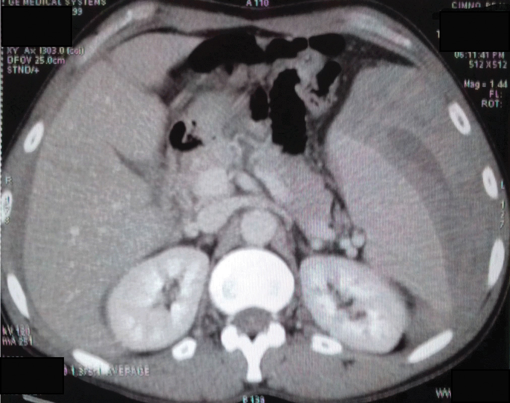 CT scan: portal enhancement: perisplenic hematoma.