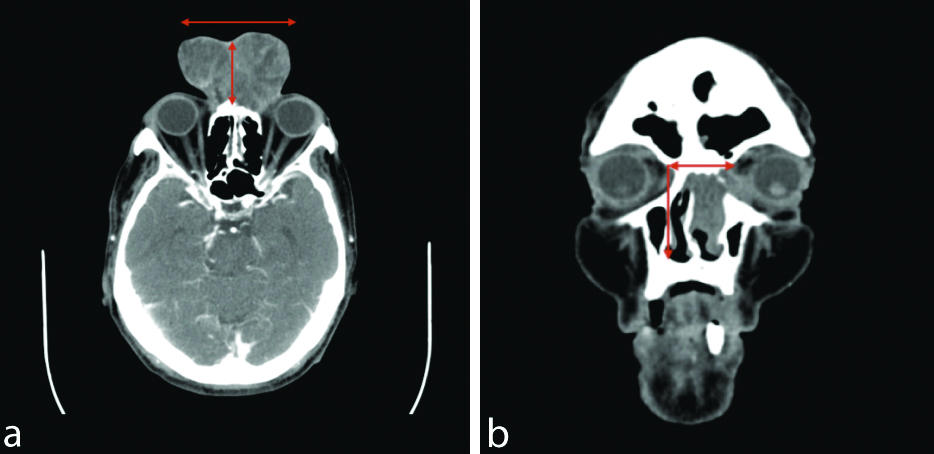 a) CECT head- axial view- showing the extension of the lesion; b) CECT ...