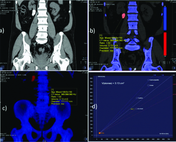 Non contrast CT scan showing stones in the renal pelvis identified on ...