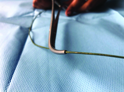 Griggs forceps- guidewire dilating forceps.