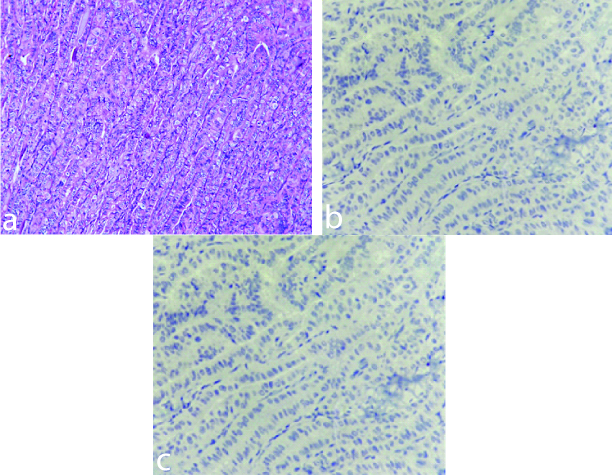 a) Tall cell variant PTC (H&E stain X100); b) Tall cell variant with ...