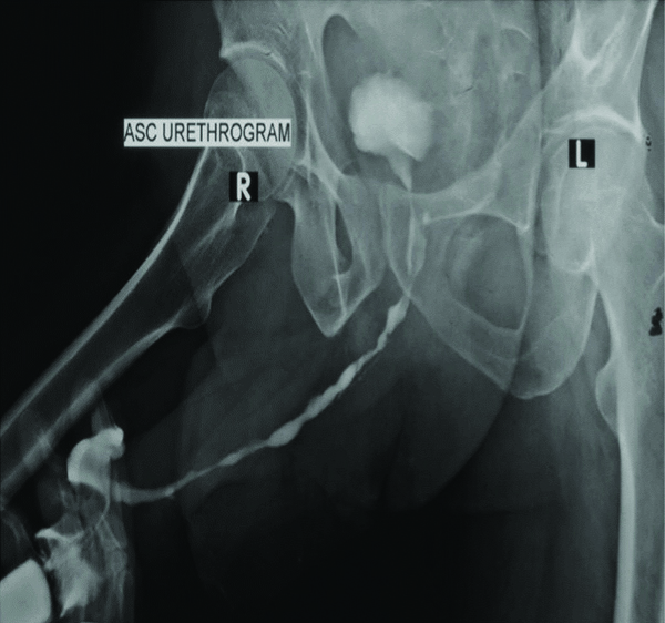 Balanitis Xerotica Obliterans Urethrogram