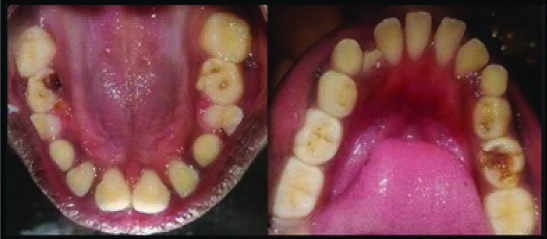 Intraoral occlusal relationships showing angle’s class I molar relation ...