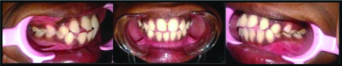Intraoral occlusal relationships showing angle’s class I molar relation ...