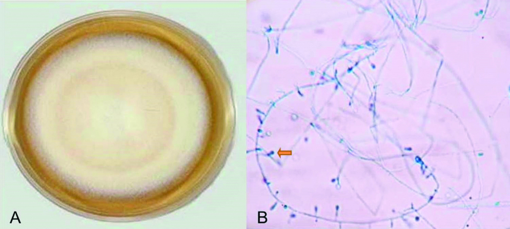Tinea Cruris Microscope