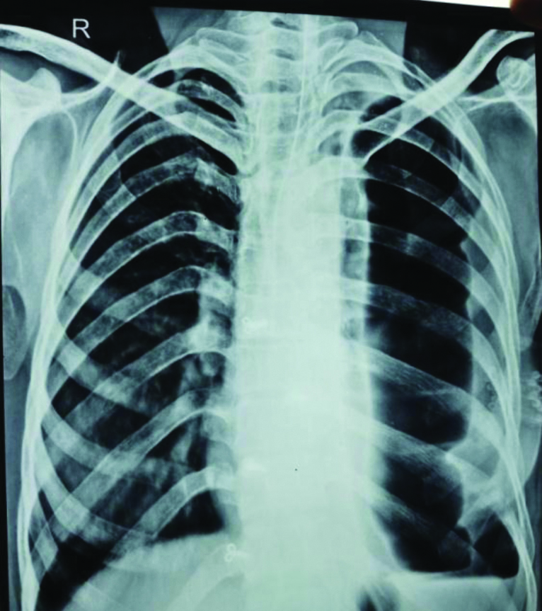 Chest X-ray of the patient at presentation showing hyperlucent left ...