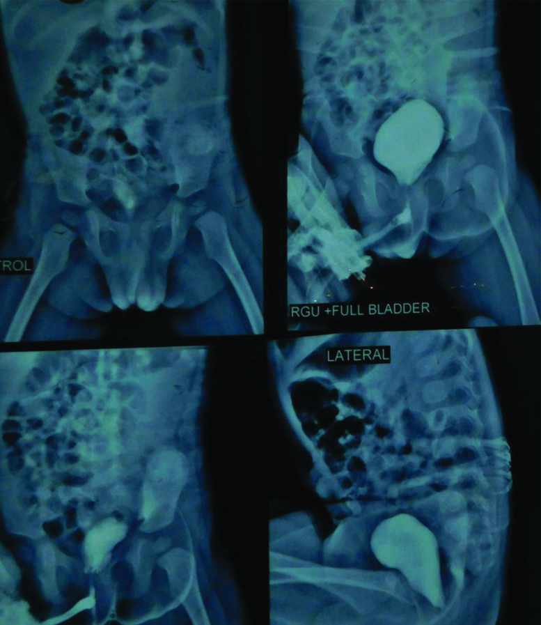 Retrograde urethrogram with micturating cystourethrogram.