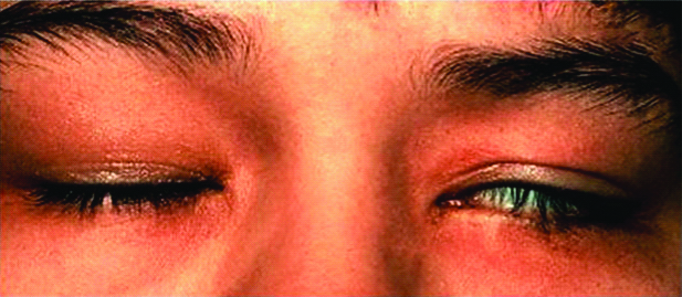 Left eye lagophthalmos.