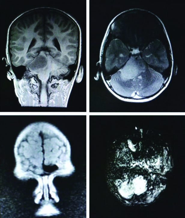 MRI showing T2 hyperintense lesion at right paramedian aspect of pons.