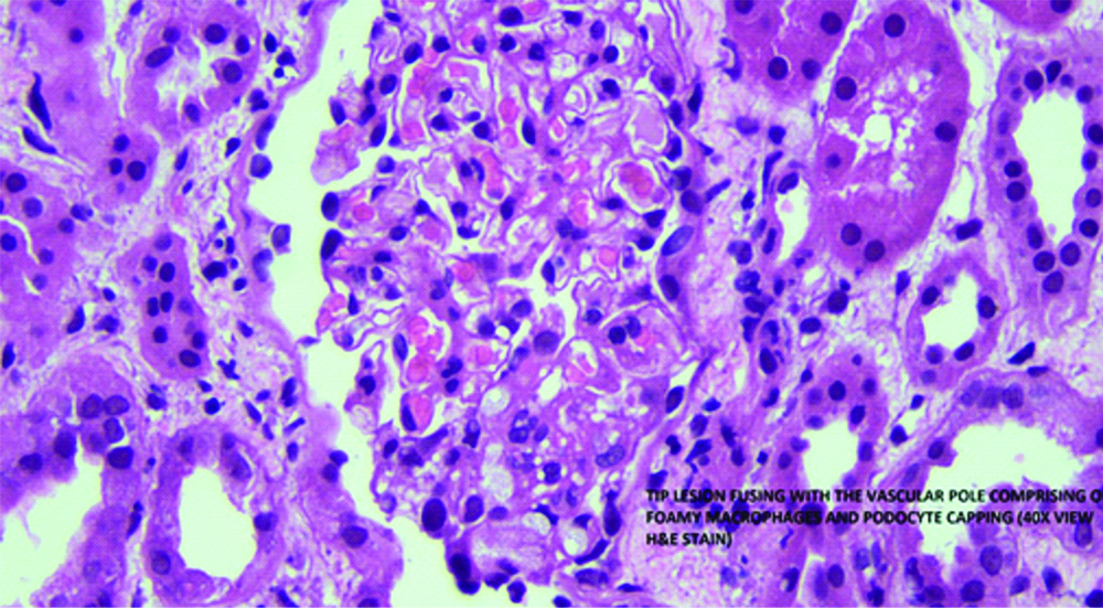 Renal biopsy showing features of Focal Segmental Glomerulosclerosis ...