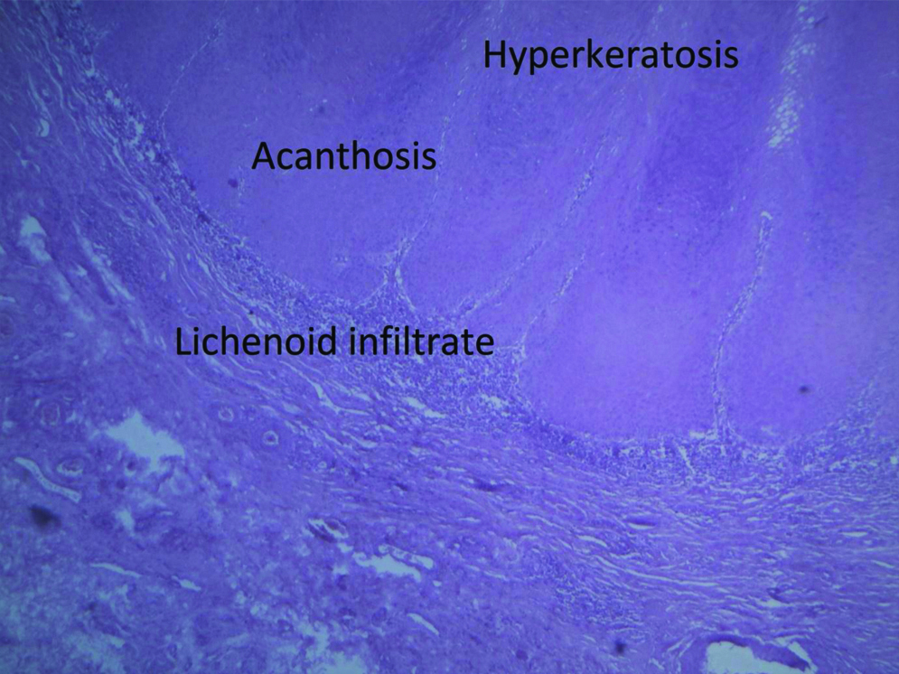 Acanthosis Histology