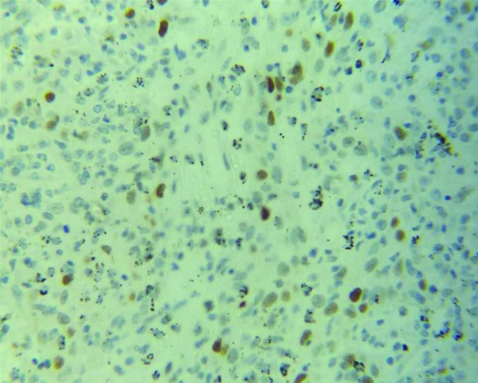 TP53 and Carcinoma Breast