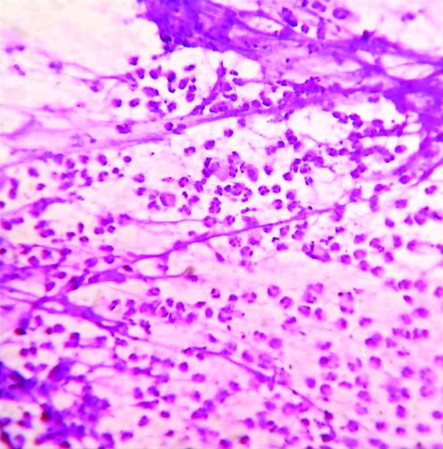 Microphotograph of cytology smear of lymphoproliferative lesion ...