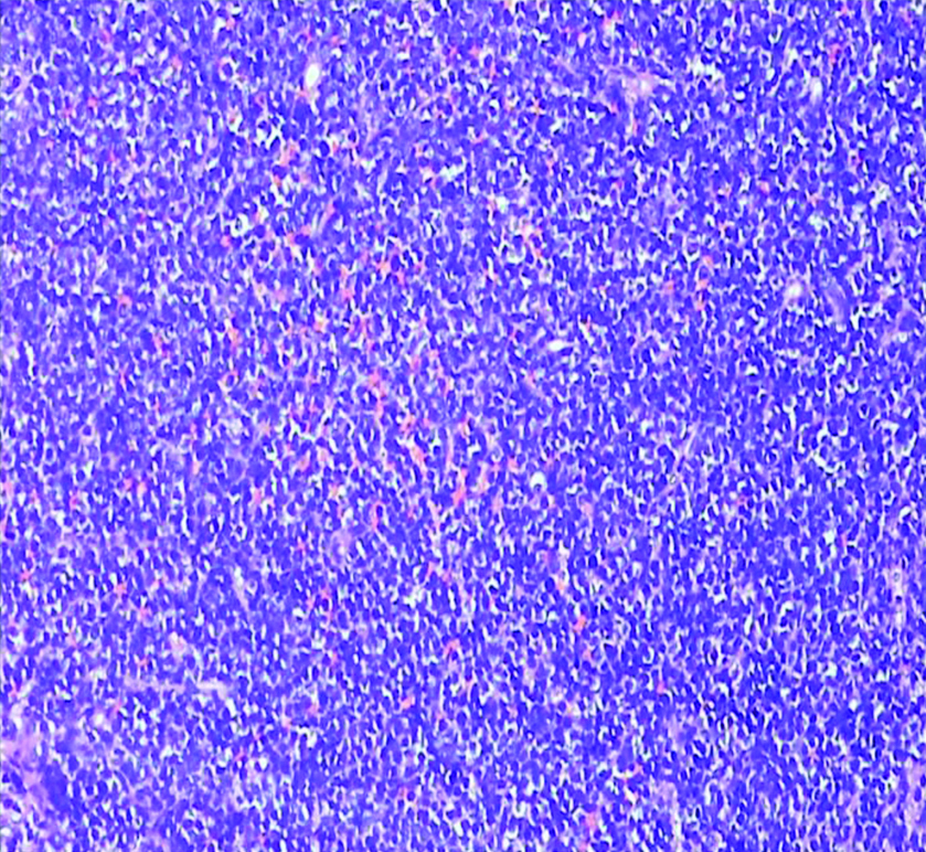 Microphotograph of cytology smear of metastatic squamous cell carcinoma ...