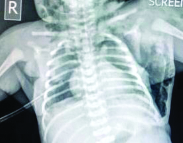 Showing right-sided pneumothorax drained using a chest tube. The ...