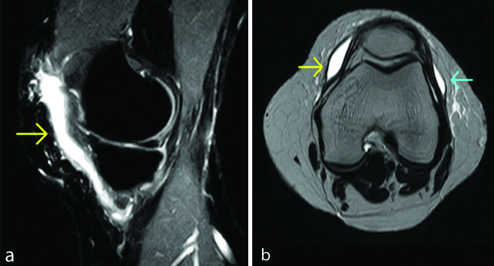 Prepatellar Bursitis Mri