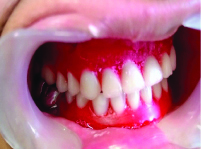 The post-insertion intra-oral photograph of the patient in: a) right ...
