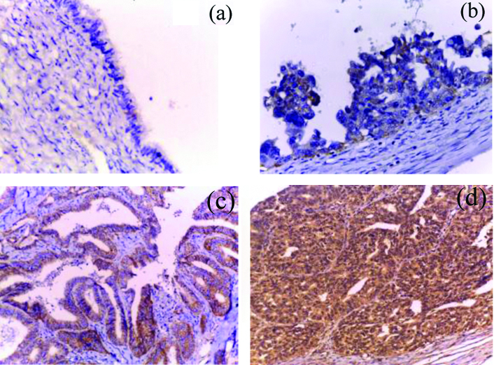 Result of Immunohistochemical (IHC) Expression of EMT Related Markers ...