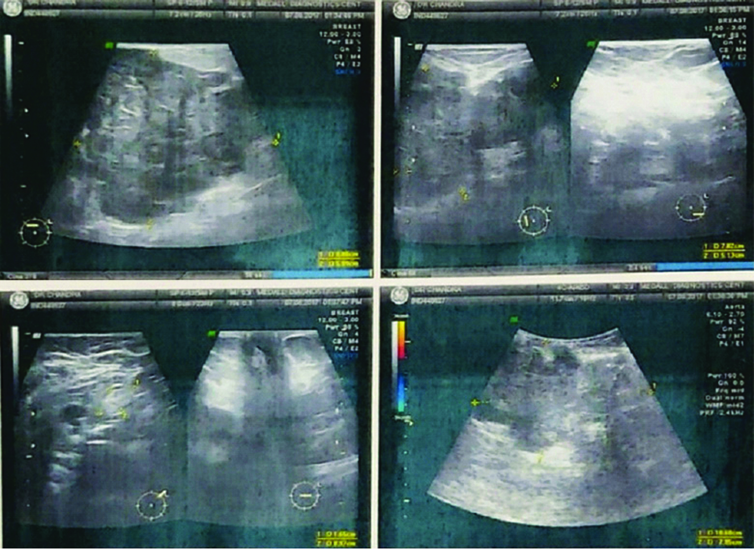 Sonomammography showing lobulated hypoechoic large lesion 20.6×17 cm in ...