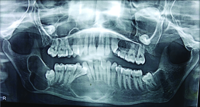 Basal Cell Nevus Syndrome Radiology