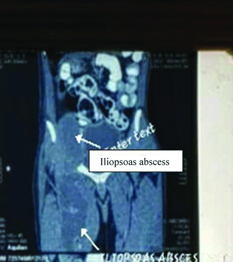 Psoas Abscess X Ray