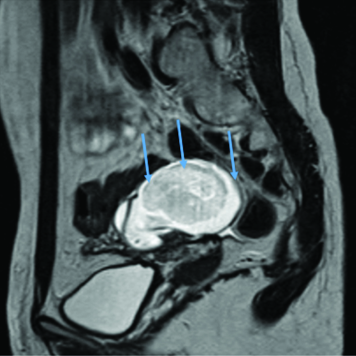 MRI T2 weighted sagittal image of pelvis through the adnexa showing ...