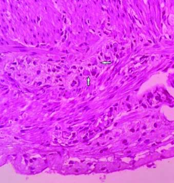 Calretinin positive staining in ganglion cells & nerve fibres in ...
