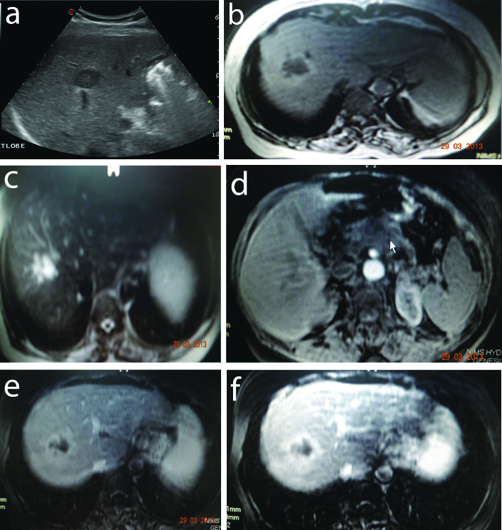 One lesion showed mild heterogenous enhancement with washout in portal ...
