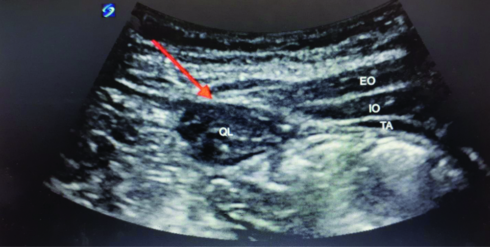 EO: External oblique; IO: Internal oblique; TA: Transversus abdominis ...