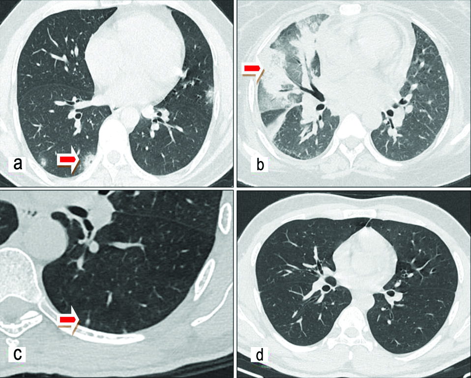 CT patterns: a) Typical (Bilateral peripheral rounded GGOs); b ...