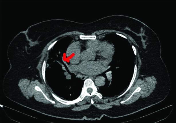 CT thorax image showing right main bronchus “cut-off” sign (Red arrow).