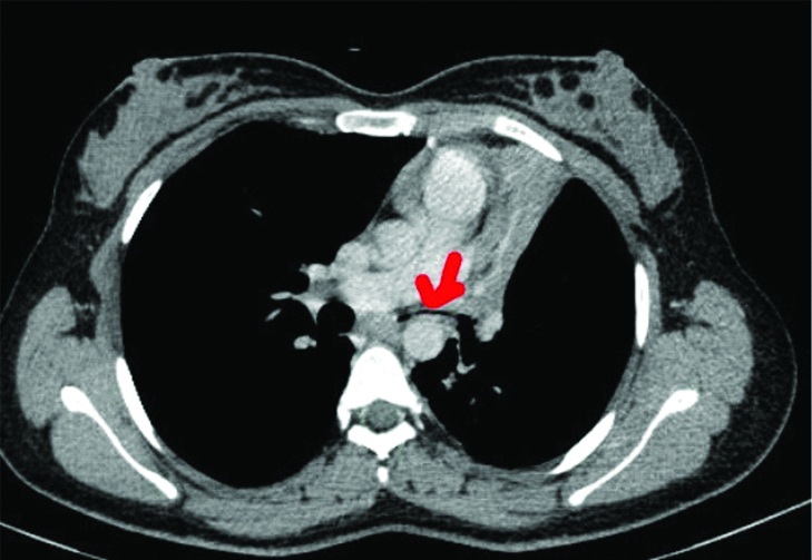 FOB showing irregular(cobble-stone) appearance of endobronchial mucosa ...