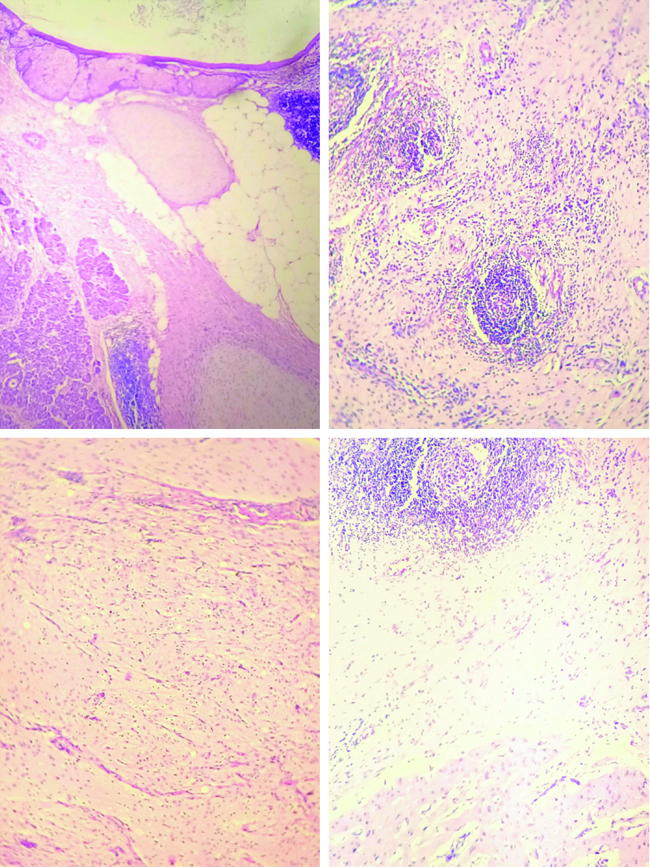 Hence, a final diagnosis of mature teratoma with predominant pancreatic ...