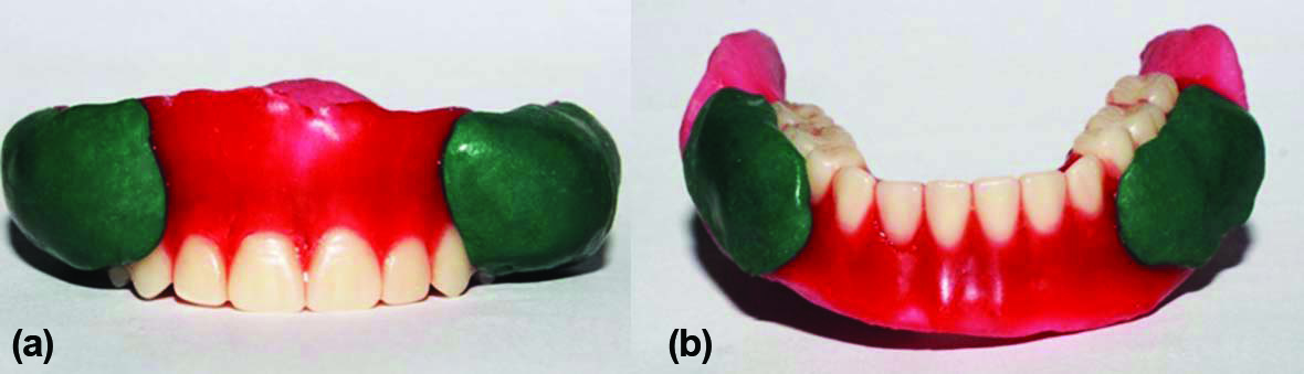 Trial dentures with green stick patterns for cheek plumpers (a ...