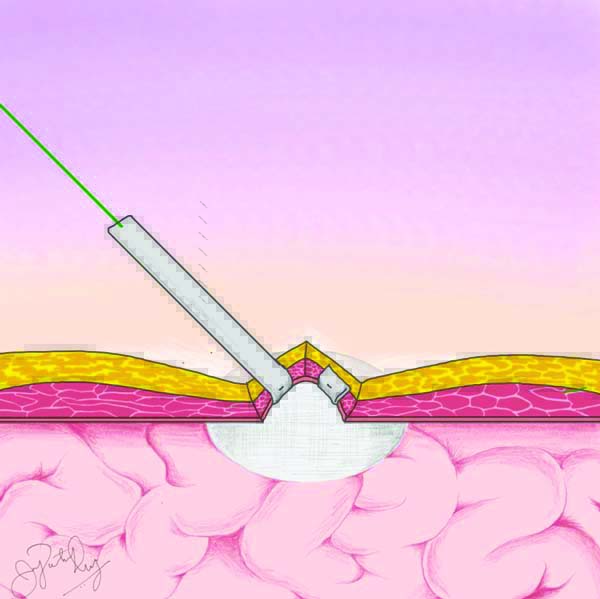 Intraoperative image of mesh placement.