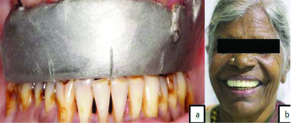 a) Jaw relation record using Aluwax; b) Frontal profile with ...