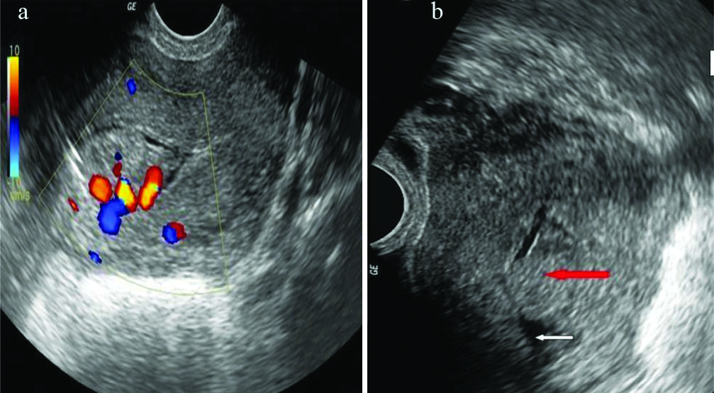 a) T2 WI axial scans, b) postsaline infusion FLAIR (White arrow ...