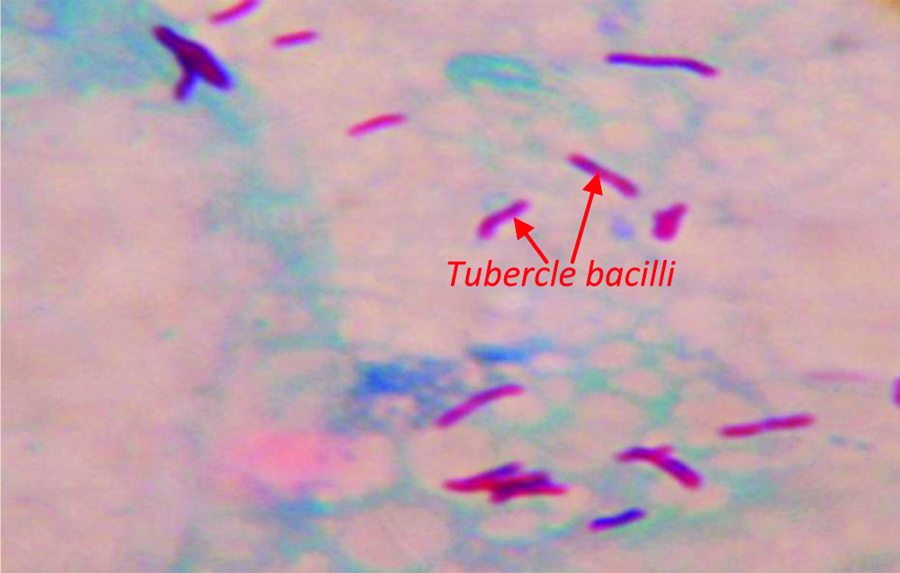 Photomicrograph depicting Acid Fast acid-fast Ziehl-Neelsen Staining of ...