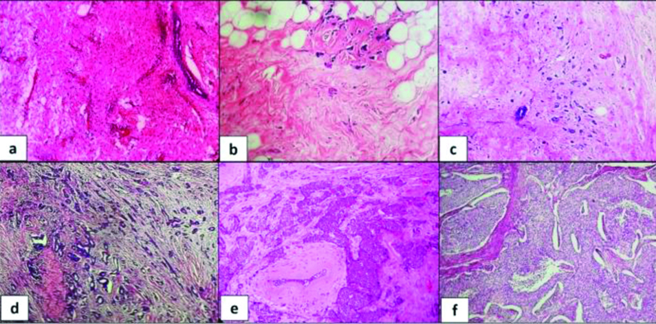 Summary pathological response and RCB class in our study.
