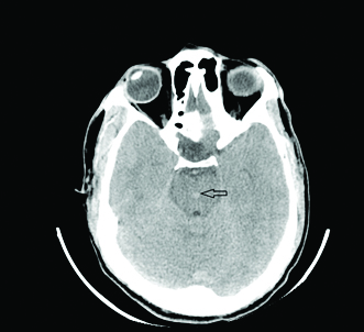 Computed tomography- (axial section) of the midbrain at the level of ...