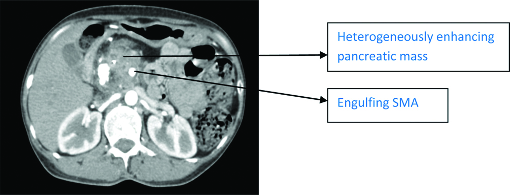 Uncinate Process Ultrasound Jcdr 15 TD01 G002.jpg