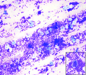 Smear showing dense acute inflammatory infiltrate along with scattered ...
