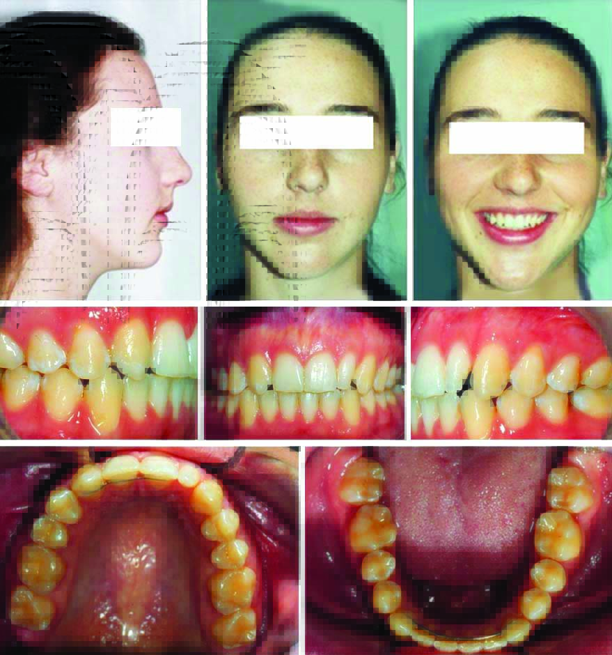A molar Class relationship was maintained on the left side and a Class ...